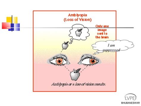Amblyopia By Surendra Ppt Eye And Vision Conditions Diseases And Conditions