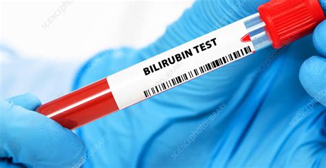 Bilirubin Test Stock Image F044 5967 Science Photo Library