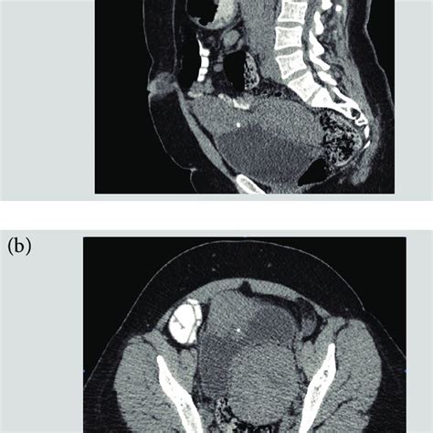 Ct Scan A Sagittal Section B Axial Section A Midline Soft Tissue