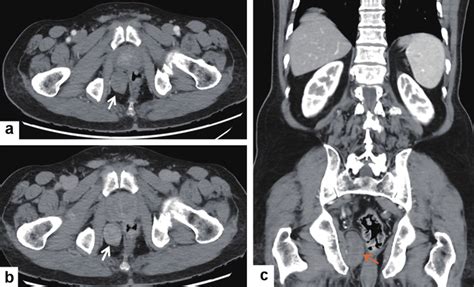 Radiological Ct Features Of Solitary Fibrous Tumor Ct January 2022