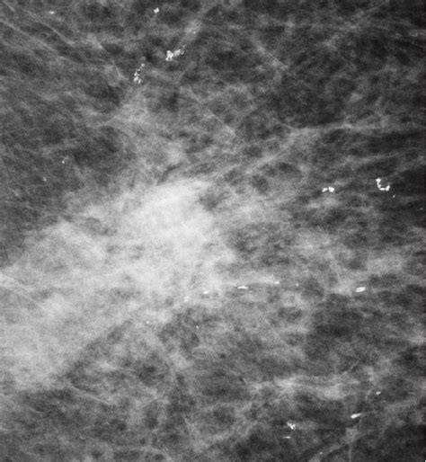 Patient 4 Scattered Punctuate Linear And Amorphous Calcifications