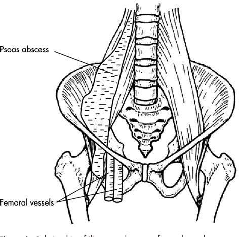Psoas Abscess Semantic Scholar