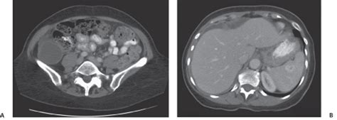 90 Malignant Mucocele Of The Appendix With Pseudomyxoma Peritonei