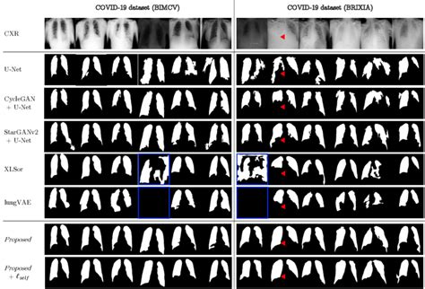 Abnormal CXR Segmentation Results On External COVID 19 Dataset Red