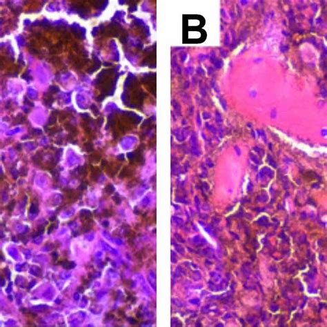 Histopathologic Findings A Polymorphic Neoplastic Cells With Clear Or