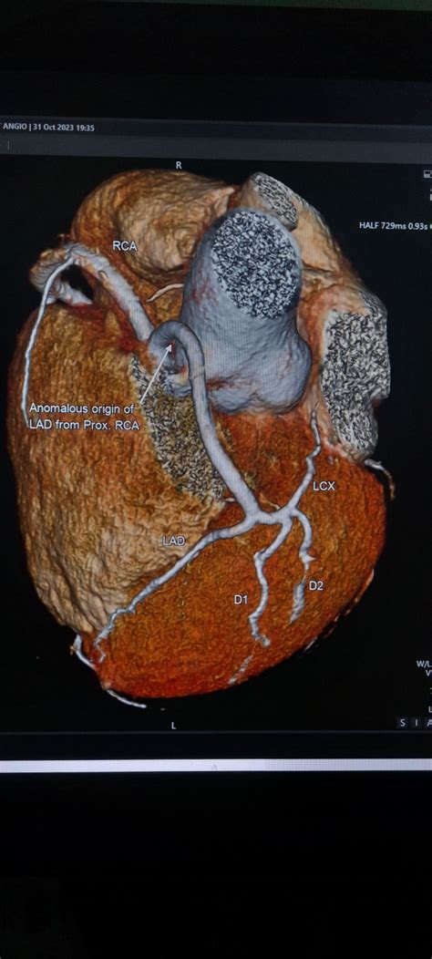 Sridhar Babu On Linkedin Absent Lmca Lad Arises From Proximal Rca