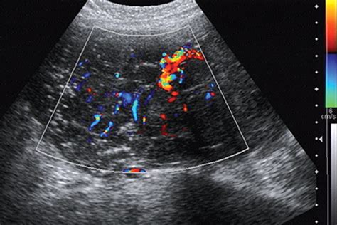 Ovarian Cancer Transabdominal Ultrasound