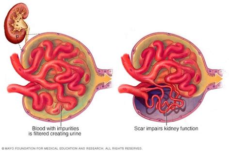 局灶节段性肾小球硬化（fsgs） 症状与病因 妙佑医疗国际