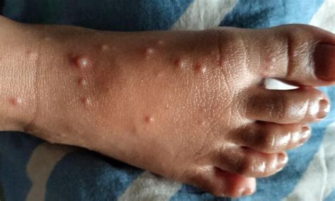 Hand Foot Mouth Disease Caused By Coxsackievirus A16 Increases In Assam