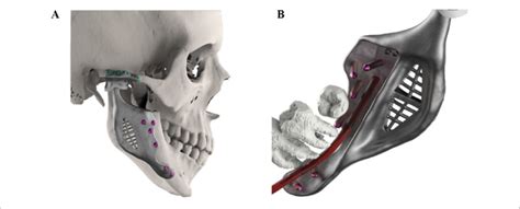 A B Pre Operative Planning Showing Custom Made Tmj Prosthesis Which