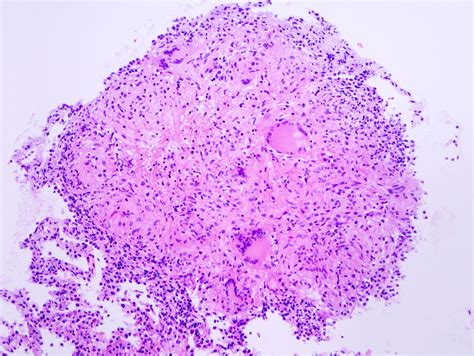 O que é um granuloma Blog Jaleko