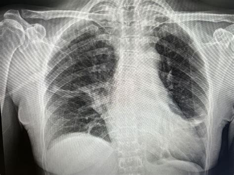 Carlos Galvez On Linkedin Last Thursday We Performed A Same Day Bilateral Anatomical Resection