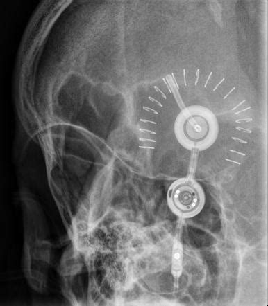 Programmable Ventriculoperitoneal Shunt Radiology Case Radiopaedia Org