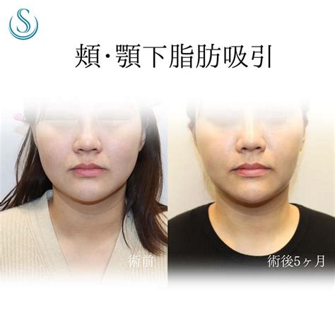 【20代女性・脂肪吸引で輪郭をくっきり】ベイザーリポ22脂肪吸引（術後5ヶ月） 症例写真 美容整形、美容外科なら聖心美容クリニック
