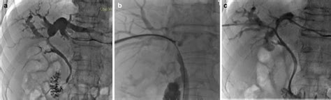 Hilar Cholangiocarcinoma Bismuth Type Iv In A 62 Year Old Woman A Download Scientific