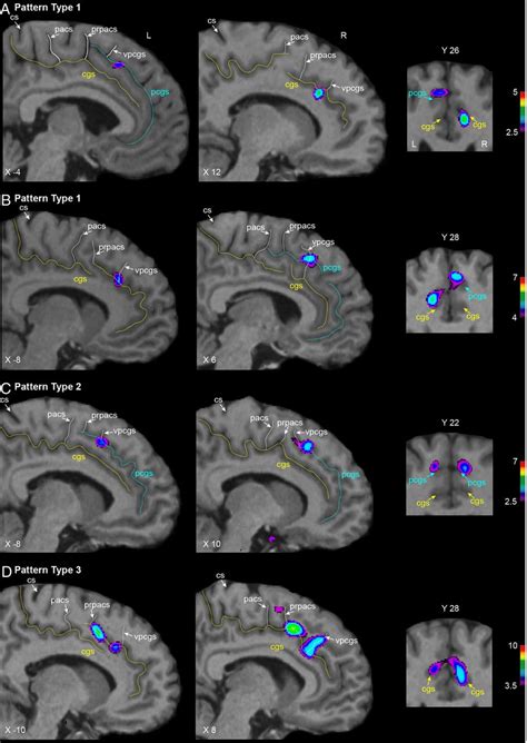 The Location Of Feedback Related Activity In The Midcingulate Cortex Is Predicted By Local