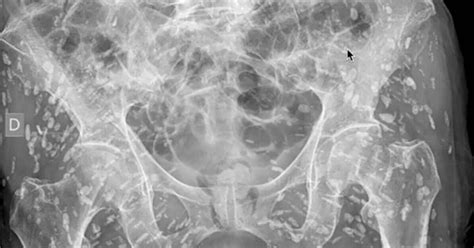 Tapeworm Infection Warning Common Kitchen Error Alert Science News