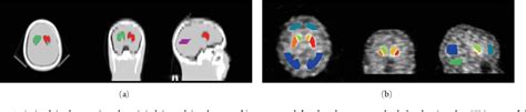 Figure 1 From The Role Of Ct Based Attenuation Correction And Collimator Blurring Correction In