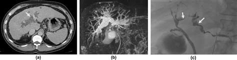 Radiological Findings In Ischaemic Cholangiopathy Clinical Radiology