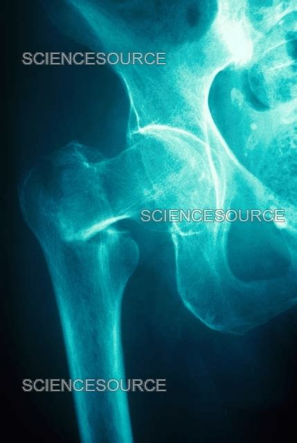 Hip Fracture And Osteoporosis X Ray Stock Image Science Source Images