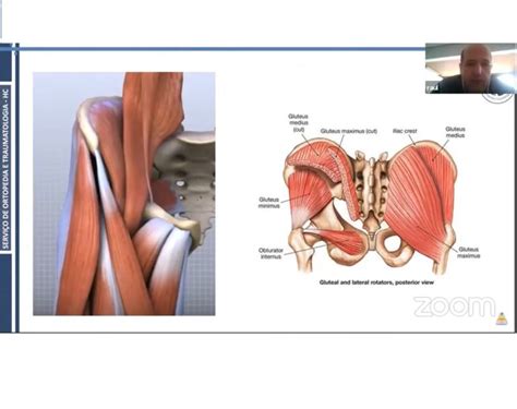 Gluteus Medius Tendon Tears —