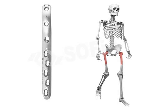 Stainless Steel Locking Proximal Femur Plate Ss At ₹ 1850 Piece In New Delhi