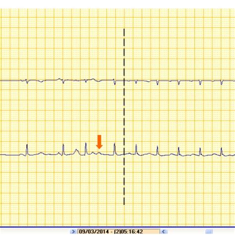 Example Of An Electrocardiogram Trace Obtained With An External Loop