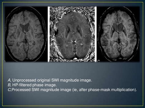 susceptibility weighted imaging swi