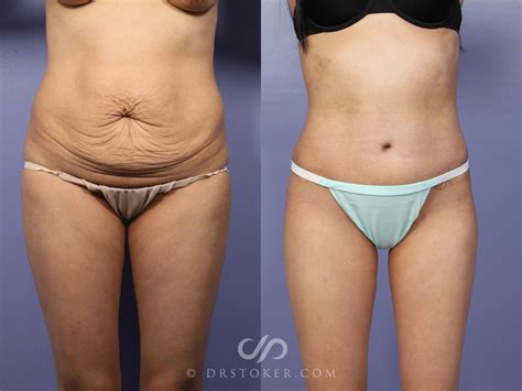 Male To Female Before And After Genitalia