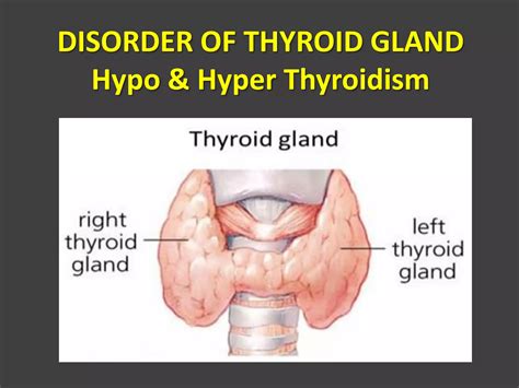 5 Thyroid Disorder Hypo And Hyper Pdf Thyroid Disorders Endocrine And Metabolic Diseases