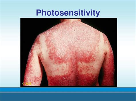 Ppt Lupus Symptoms Diagnosis And Treatment Powerpoint Presentation