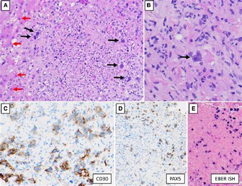 Photomicrographs Of Liver Biopsies From Study Patients A And B