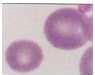 강 적 유 Kelainan Bentuk Eritrosit Red Blood Cell