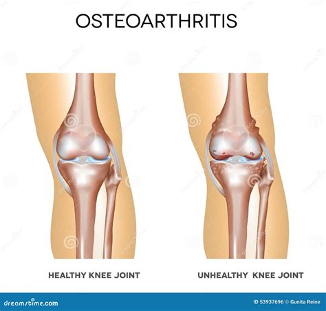 Healthy Knee And Knee With Osteoarthritis Stock Vector Image 53937696