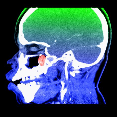 Nasopharyngeal Angiofibroma CT Scan Bild Kaufen 12036520 Science