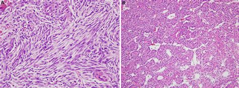 The Who 2021 Thymoma Classification A Work In Progress