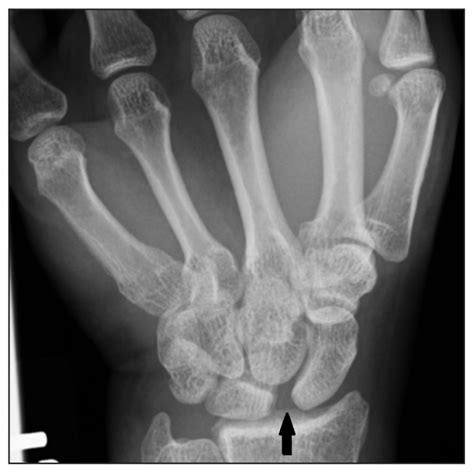 Scapholunate Dislocation