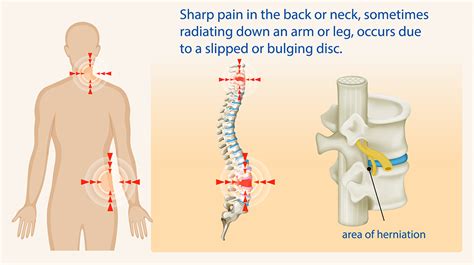 Cervical Herniated Disc Ripple Chiropractic