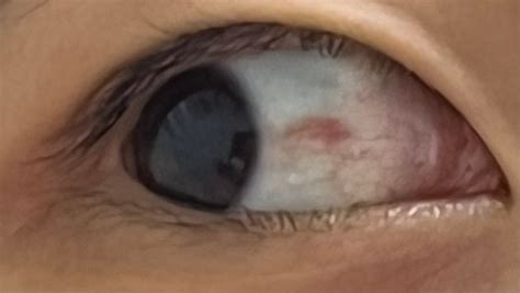 눈 흰자에 빨간 점 지식in