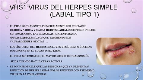 Historia Natural Del Herpes Agente Vhs 1 Herpes