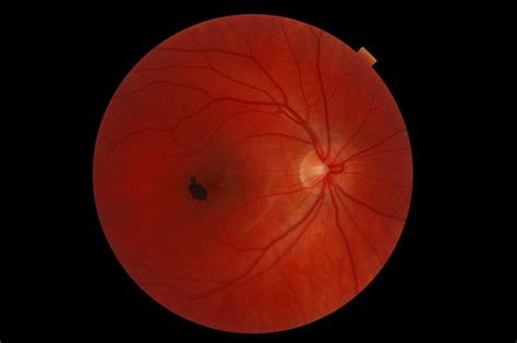 Medical Eye Conditions Roswell Ga Focus Eye Care Inc