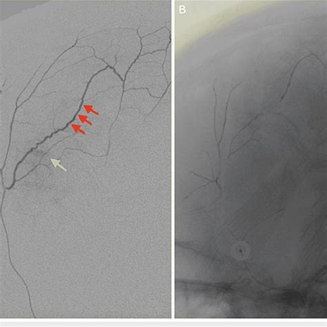 Microcatheter Positioning During Middle Meningeal Artery Embolization