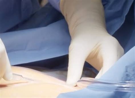 Subxiphoid Pericardial Window Meaning Procedure Ultrasound Technique