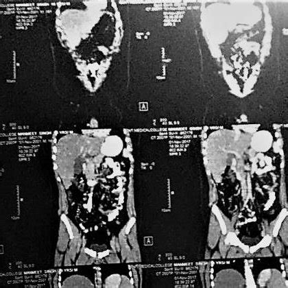 CT Scan Of Abdomen Showing Swollen Appendage In The Subhepatic Region Download Scientific Diagram