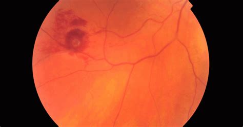 Management Of A Retinal Arterial Macroaneurysm The Journal Of Medical