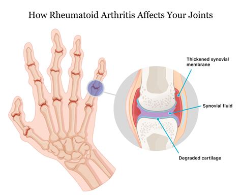 Early Signs Of Arthritis In Fingers Finger Arthritis Signs Symptoms