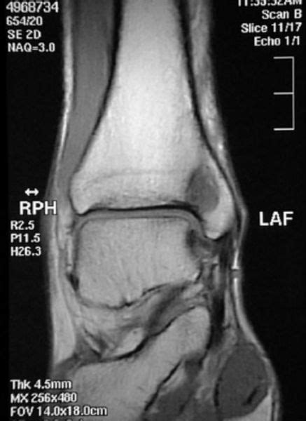 Intraosseous Ganglion Wikidoc
