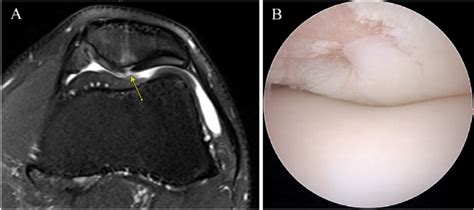 Chondral Lesion Of The Patellar Median Ridge Left Knee A Axial T2