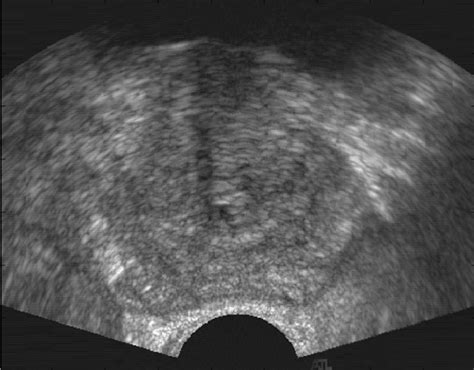An Example Of Registration To Missing Data Prostate Biopsy Results Download Scientific Diagram