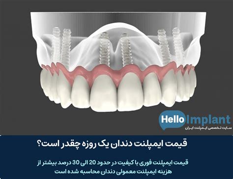 کاشت ایمپلنت فوری دندان چیست؟ قیمت ایمپلنت دندان یک روزه چقدر است